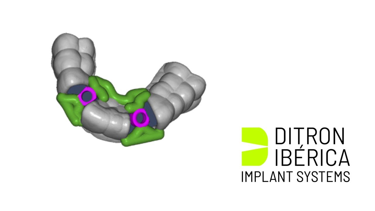 Carga inmediata con guía piloto e implantes Ditron - YouTube