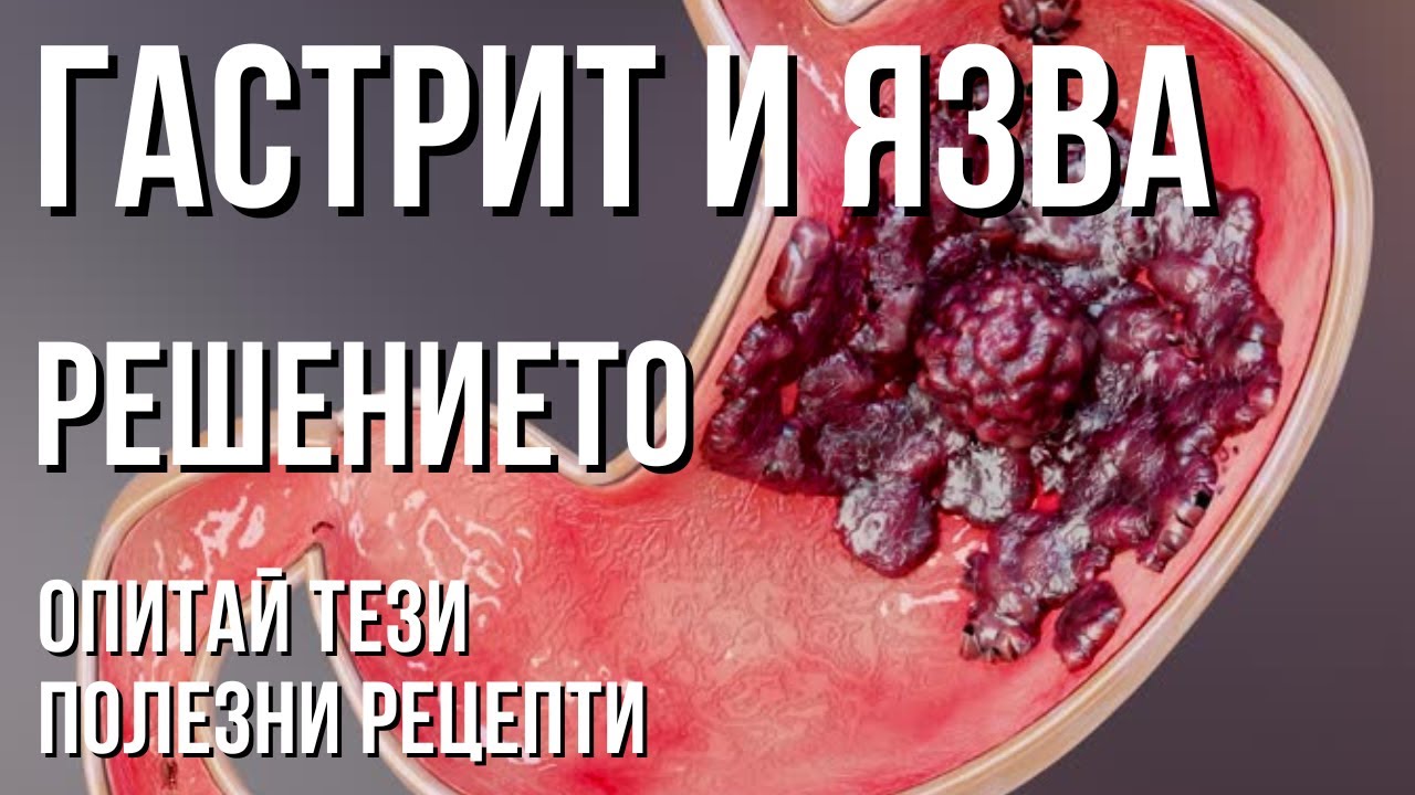ЯЗВА И ГАСТРИТ 9 ДОМАШНИ РЕЦЕПТИ ЗА ЛЕЧЕНИЕ НА ЯЗВА Youtube