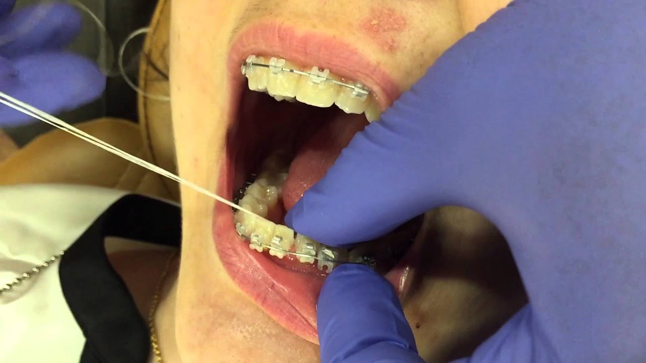 Floss Method to Engage Wire in a Rotated Tooth - YouTube