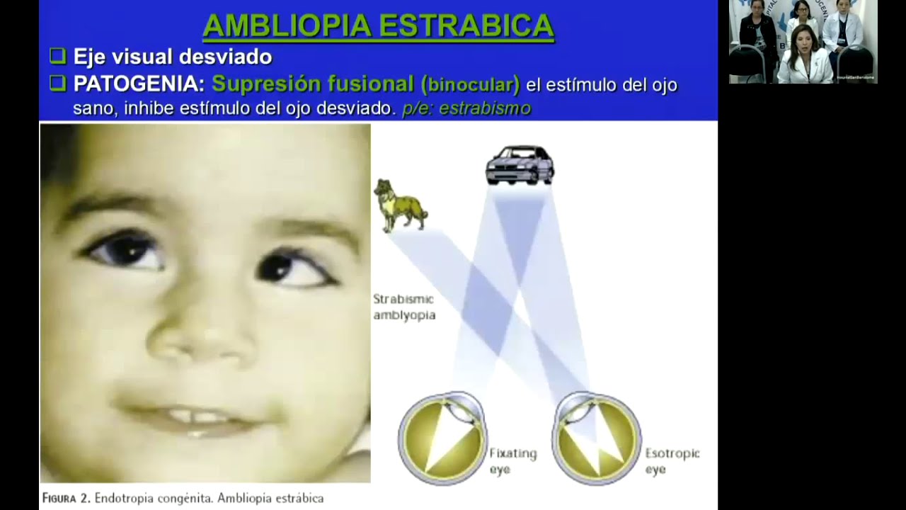 AMBLIOPIA (OJO PEREZOSO) - YouTube