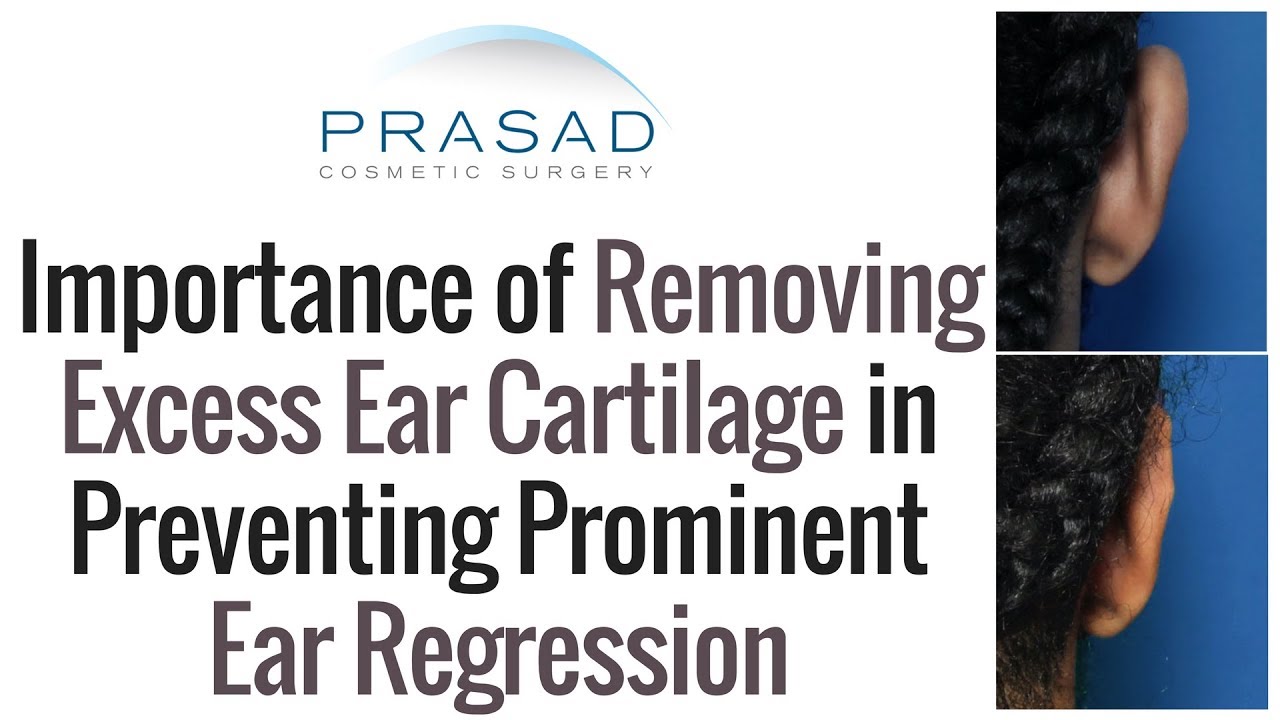 Why Removing Excess Cartilage is Important in Otoplasty to Prevent ...