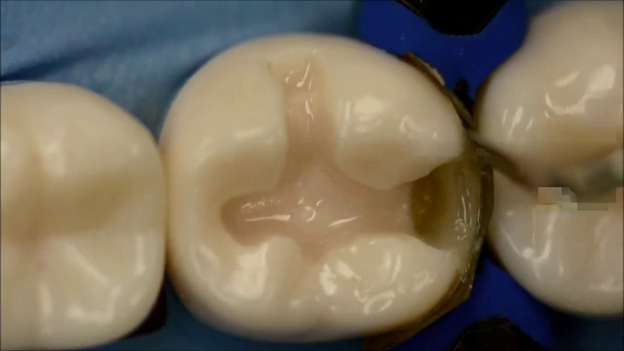 Class II Composite Marginal Ridge Build-up by Dr. Alex Delgado - YouTube