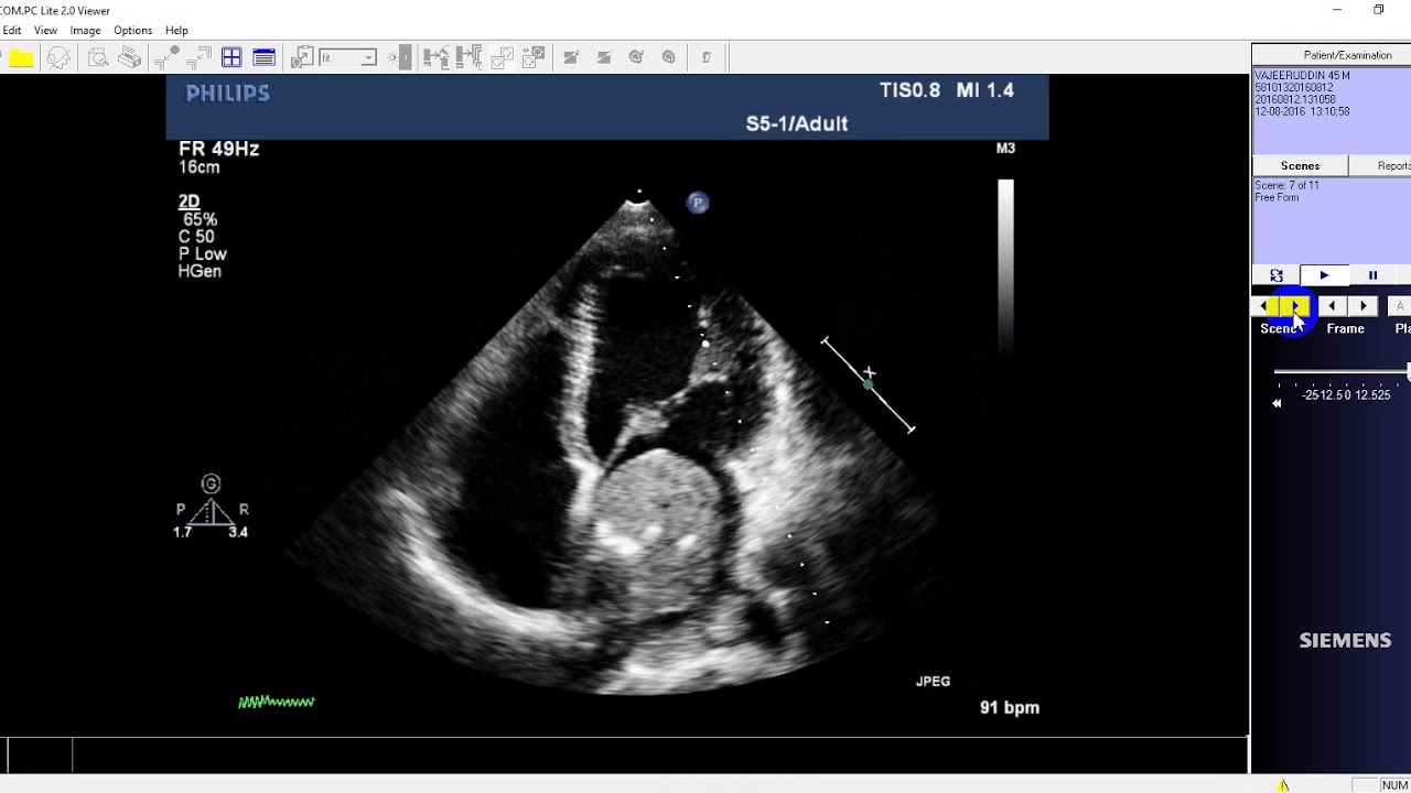 LEFT ATRIAL MYXOMA (LA MYXOMA) - YouTube