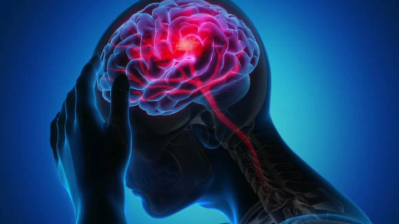 When it comes to Stroke, Time is Brain - YouTube