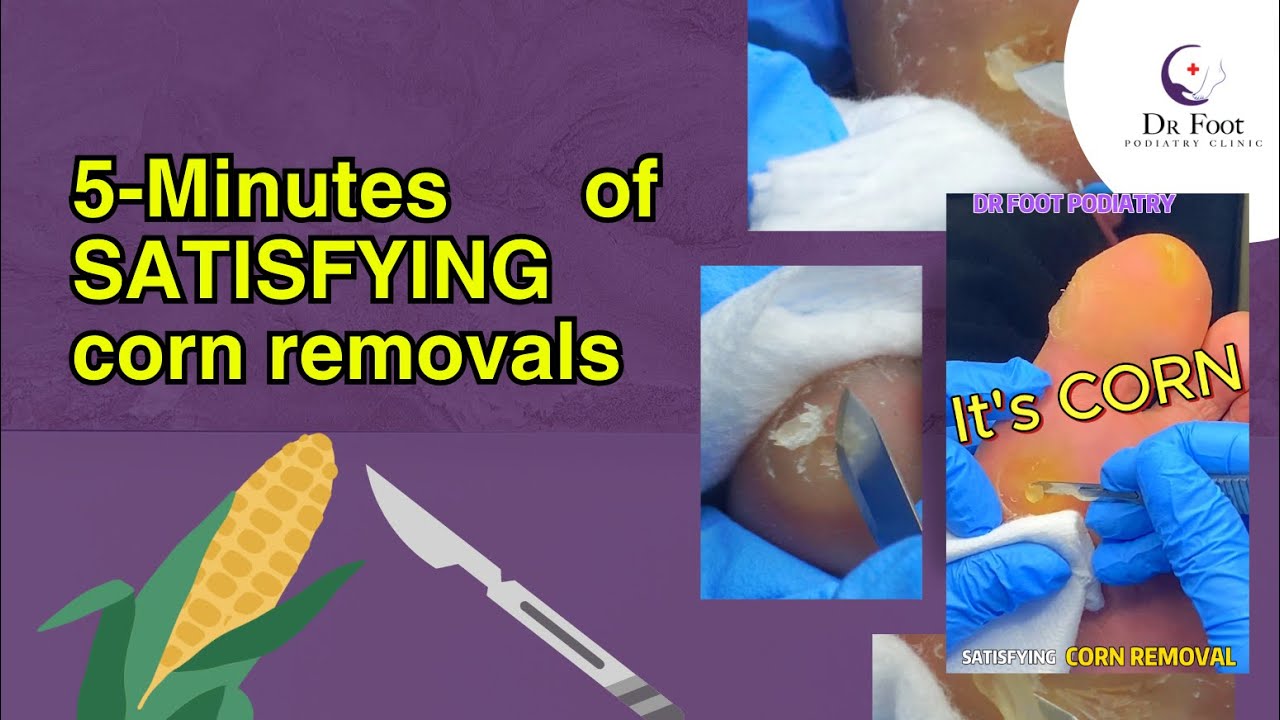 SATISFYING CORN & NAIL MANAGEMENT!! - YouTube