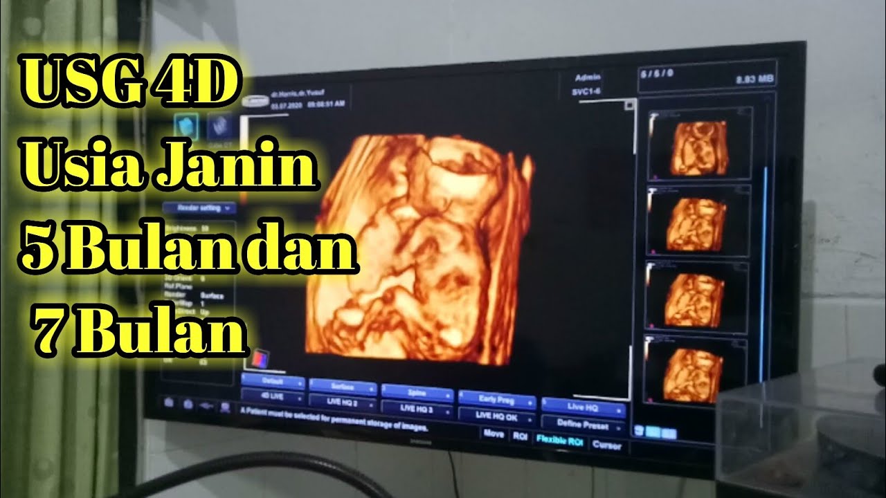 USG 4D Hasil Lebih Jelas || Hasil USG Janin 5 bulan dan 7 Bulan - YouTube
