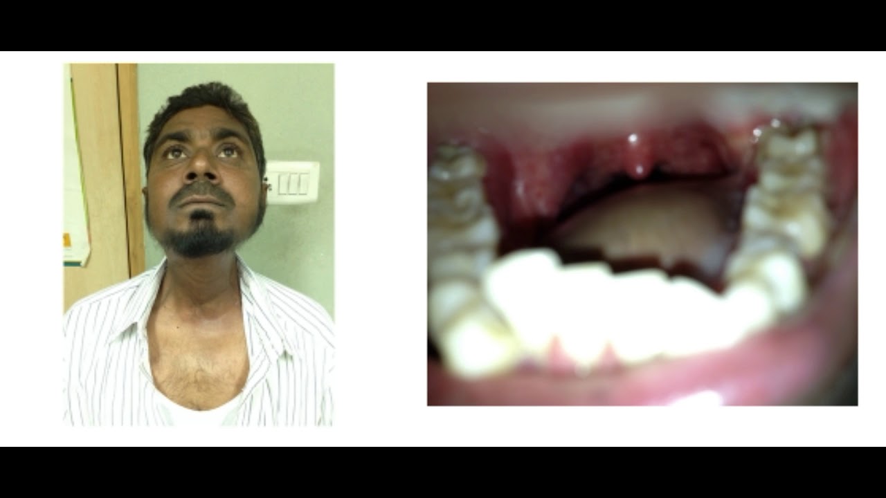 Compartment Tongue Resection - S Kannan - OM 5.0 (ONCO SURGERY MASTER ...