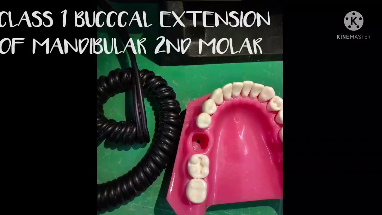 typhodont tooth exercise : Class 1 buccal extension of mandibular 2nd ...