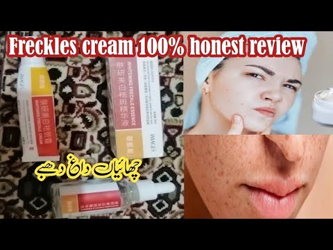 whitening freckle cream honest review / best treatment for pigmentation ...