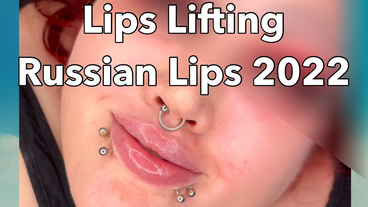 Russian Lips 2022 - Filler Technique - Volume and Lifting - YouTube