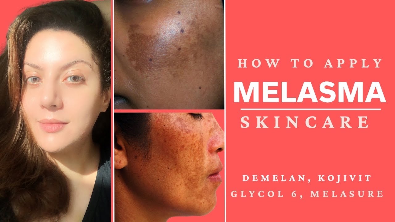 How to apply Melasma treatment creams | Nipun Kapur - YouTube