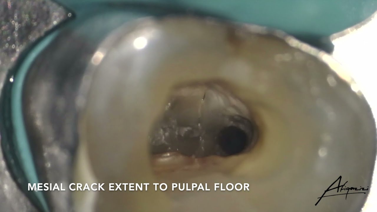 Vertical Root Fracture(VRF) under magnification of dental microscope ...