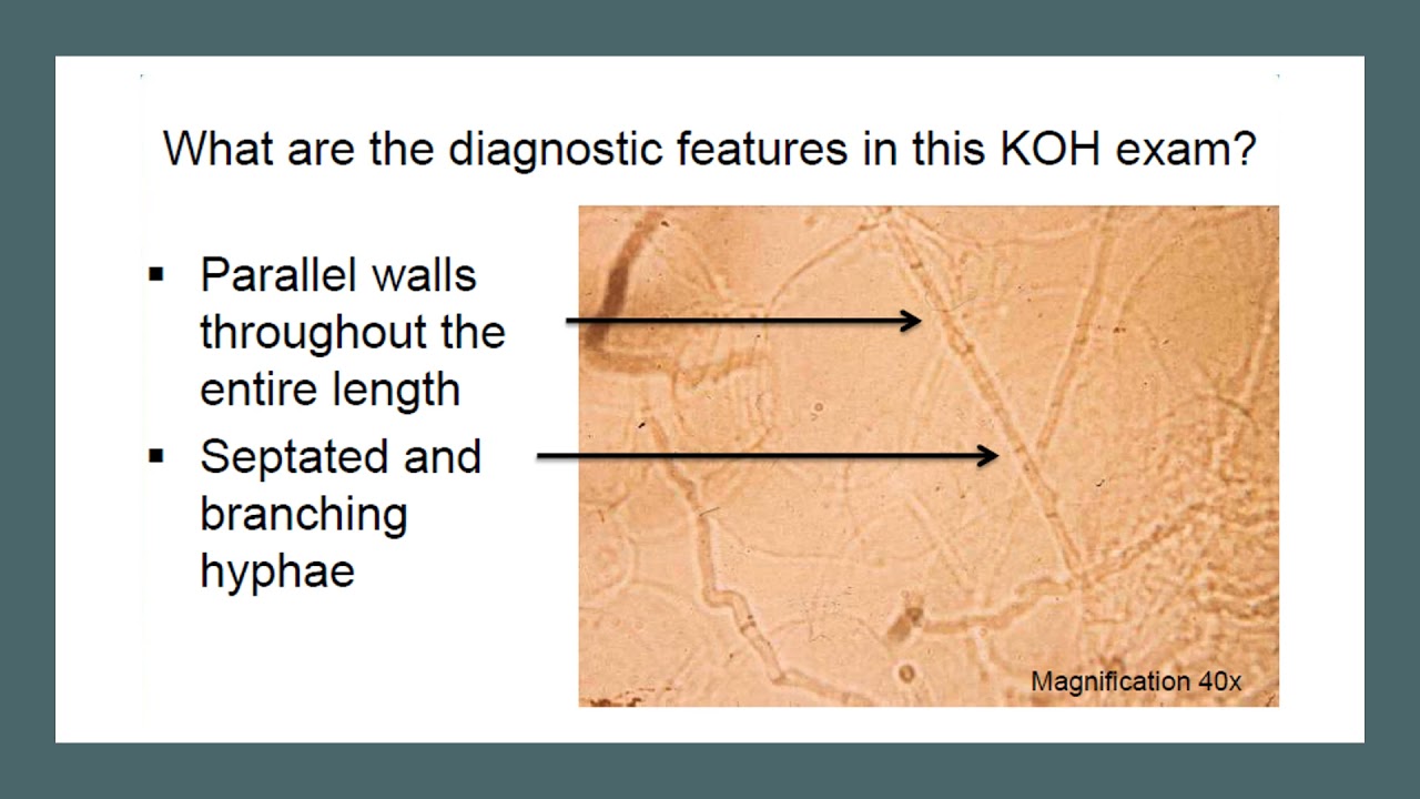 Dyspigmentation. Lecture for undergraduates, Dr. Nermeen Bedair - YouTube