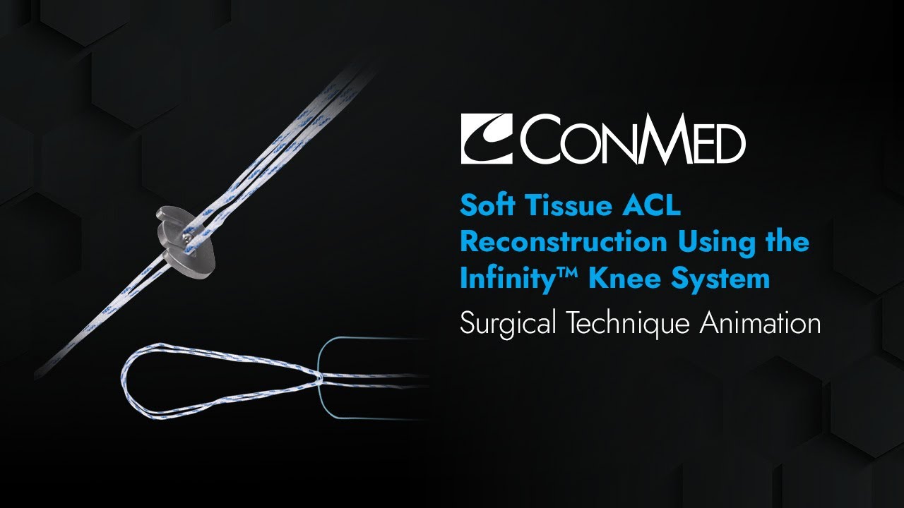 Soft Tissue ACL Reconstruction Using the Infinity™ Knee System - CONMED ...