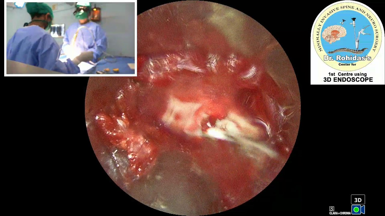 Lt. L4/5 & L3/4 endo discectomy. - YouTube