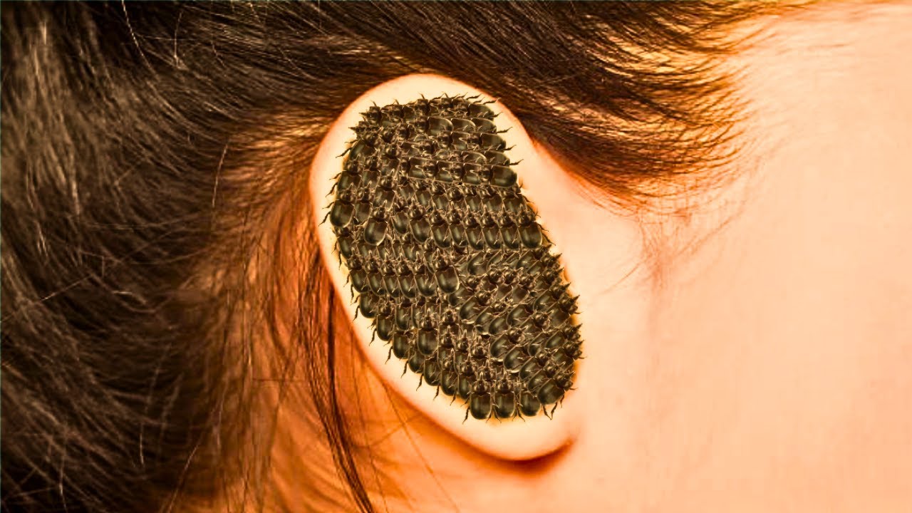 Heavy Infected Ear Treatment | ASMR Animation | Remove Trypophobia ...