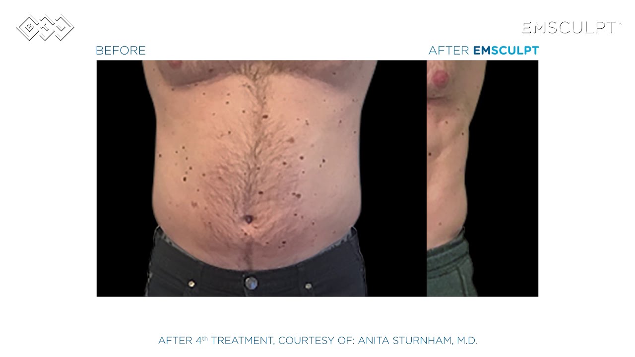 EMSCULPT®: Check out the treatment results! - YouTube