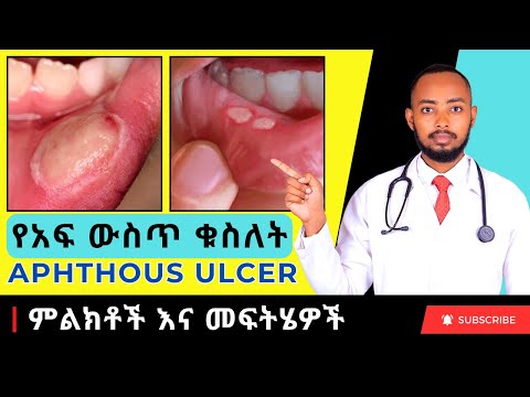 Ethiopia | የአፍ ውስጥ ቁስለት (Aphthous ulcer) መፍትሄዎች