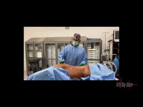 Top 5 Liposuction Systems: Vibrasat Pro Microaire Instructional Video ...