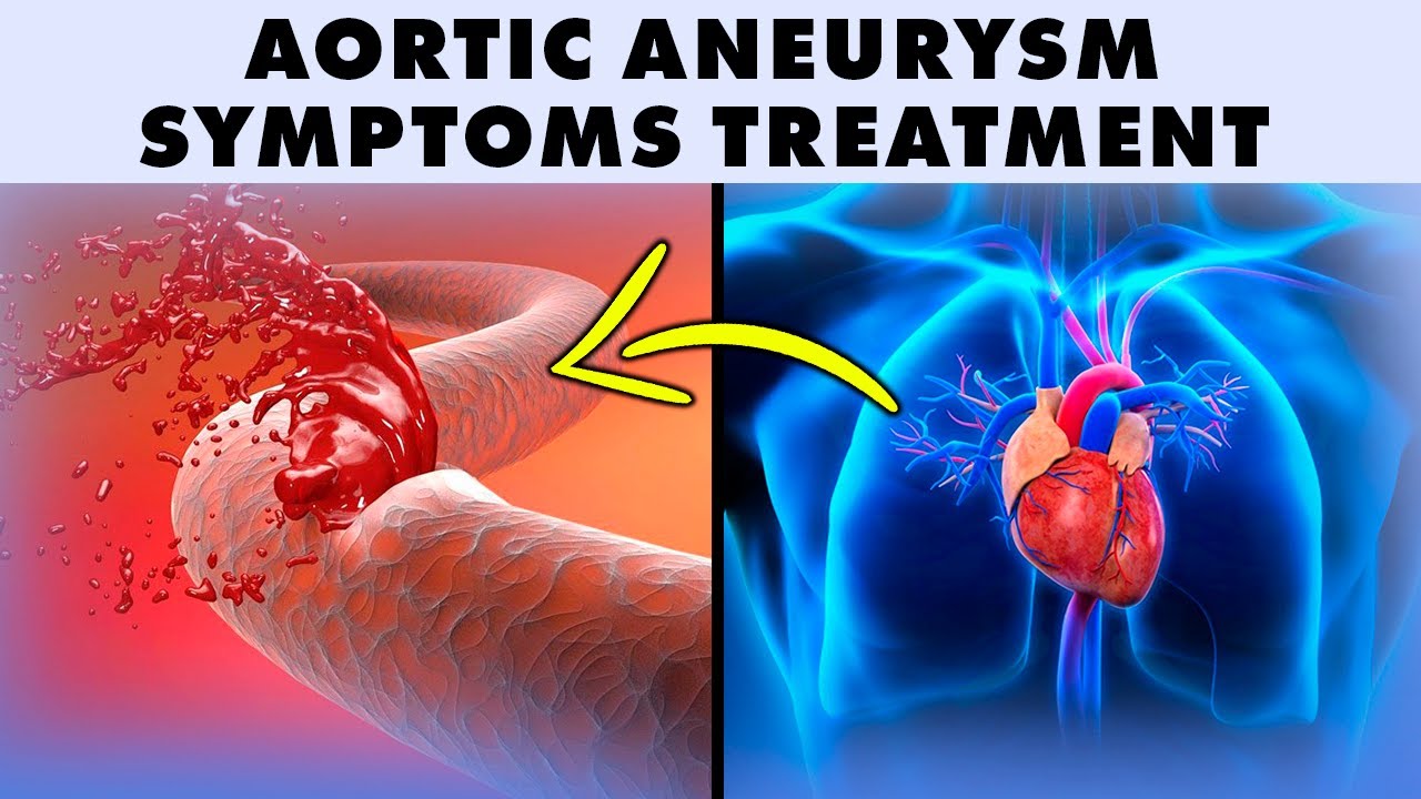 WHAT IS AN AORTIC ANEURYSM? | 3D ANIMATION - YouTube