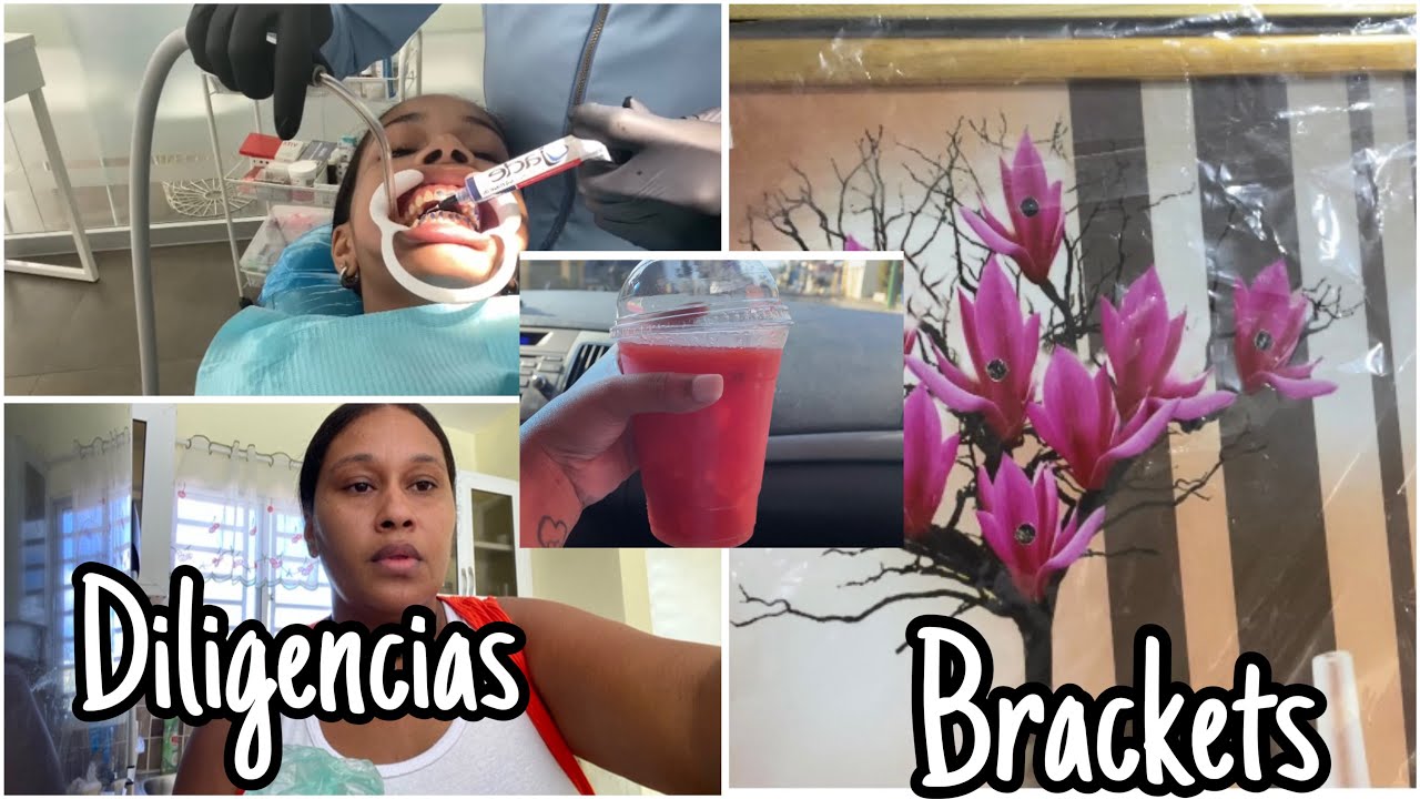 Colocación de brackets/ Días activos/ voy al 20 y 10 - YouTube