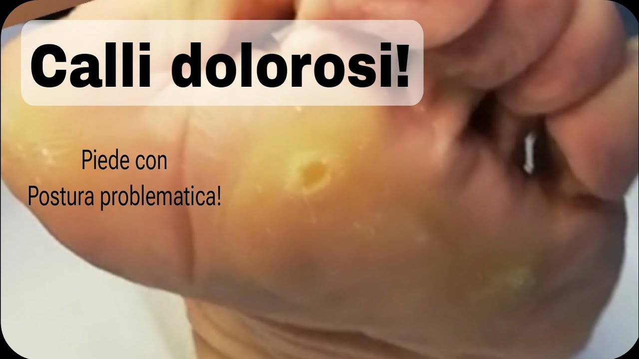 Calli dolorosi sotto la pianta del piede! Tutorial Pedicure importante ...