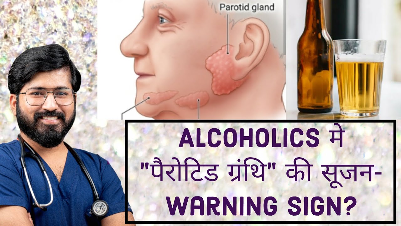 Warning sign of Parotid swelling in alcoholics ।। शराब पीने वालो मे ...