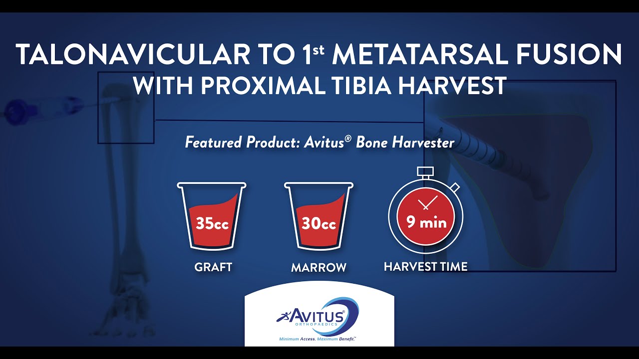Avitus® Bone Harvester - Medial Tibia Harvest - YouTube