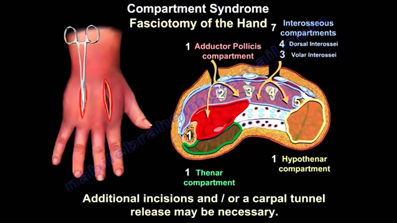 Síndrome Compartimental da Mão - YouTube