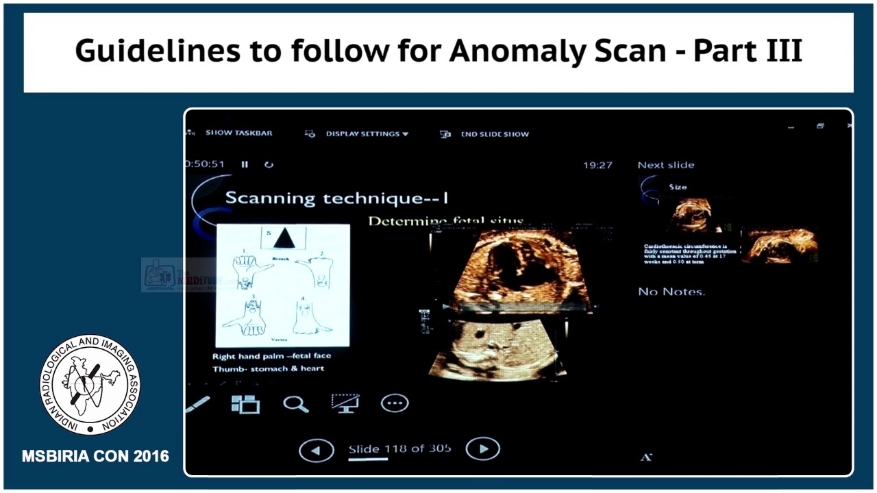 Guidelines to follow for Anomaly Scan - Part III - YouTube