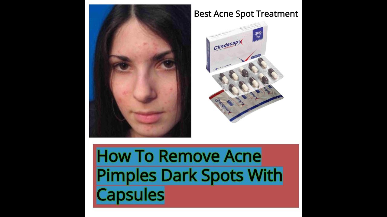 Acne Removal Capsule | Best Acne Pimple Removal Solution | Remove Dark ...