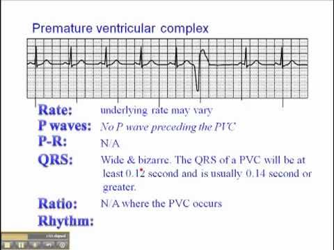 ECG: Premature Ventricular Complexes (PVC) - YouTube