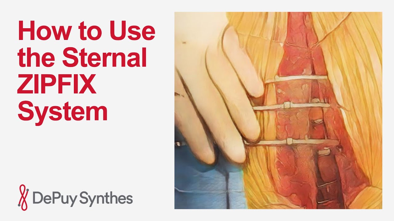 Sternal Closure Technique with the Sternal ZIPFIX System by Dr. Terry ...