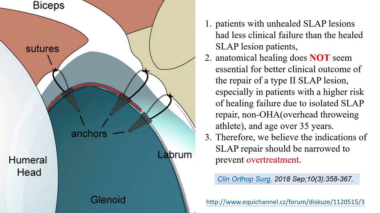 SLAP lesion: any place for ultrasound? - YouTube
