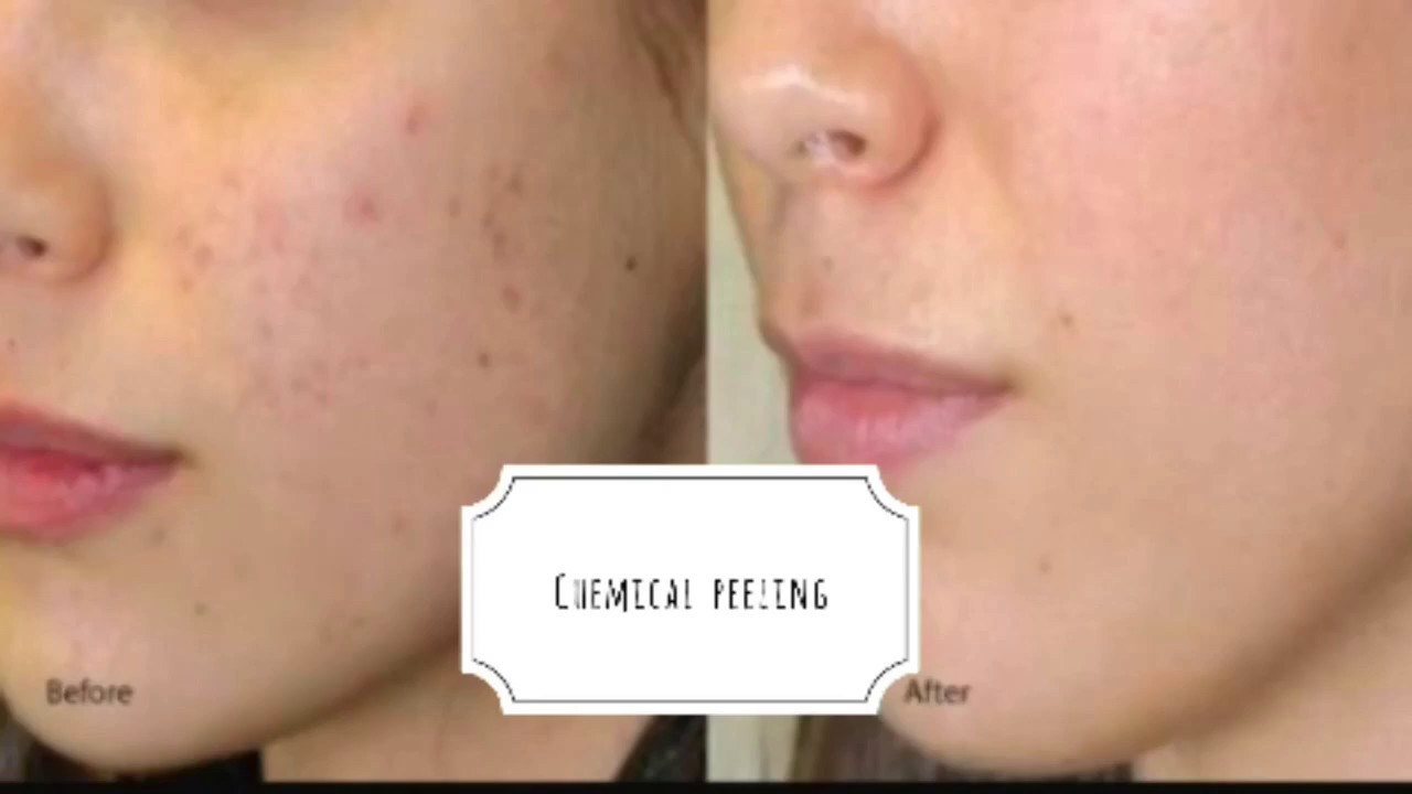 Chemical Peeling For Acne Scars At Home - YouTube
