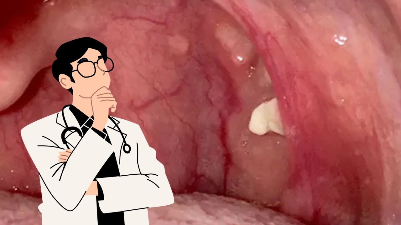 This Is How Tonsil Stones Were Formed! 🤗 - #gigital #doktergigigaul ...