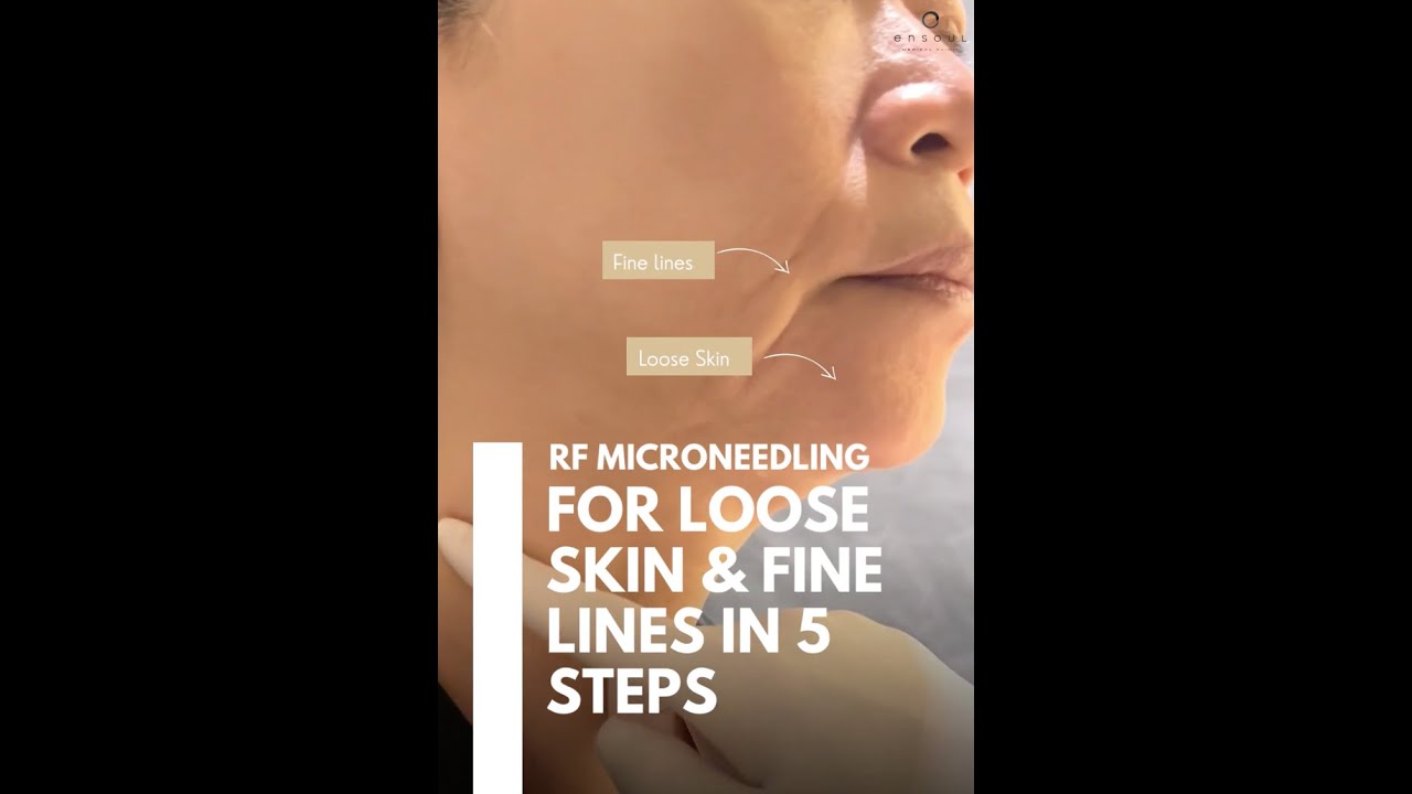 RF Microneedling for Fine Lines and Loose Skin | Ensoul Medical Clinic ...