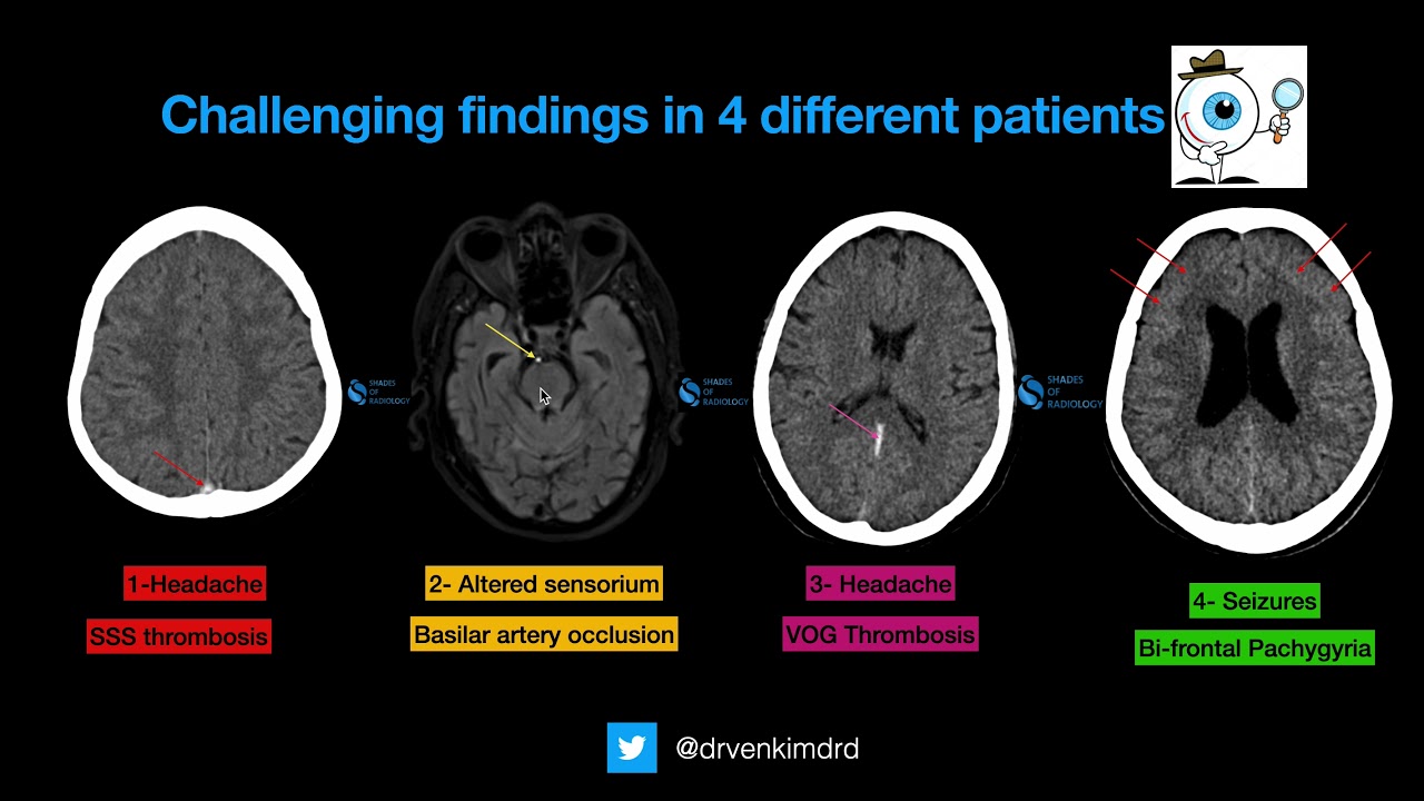 Subtle findings on imaging - Not to miss - YouTube