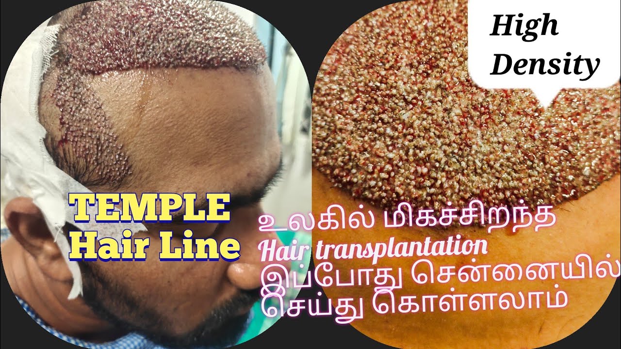 TEMPLE Hair Line... High Density. உலகில் மிகச்சிறந்த Hair ...