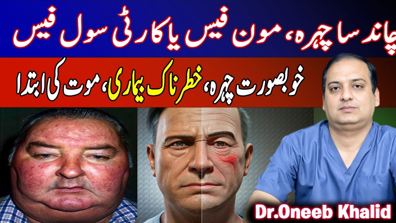 Chand Sa Chehra Ya Khatarnak Bemari? 😱 Cushing Syndrome Alamat Aur Ilaj ...