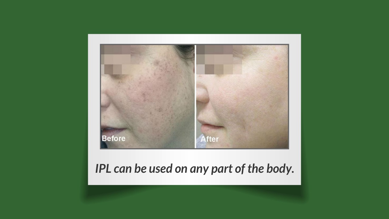 Intense Pulsed Light Treatment Woodbury, MN | Rocheford Plastic Surgery ...