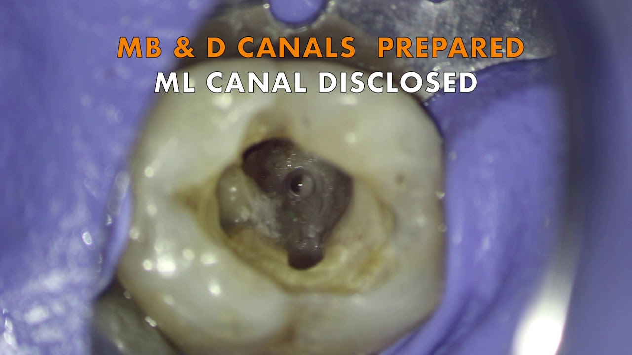 REPAIR OF A CERVICAL PERFORATION SECONDARY TO INTERNAL RESORPTION - YouTube