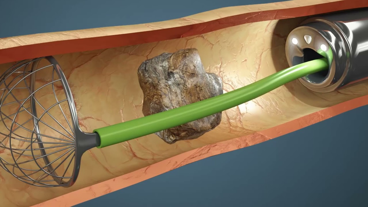 Rigid Ureteroscopy - YouTube