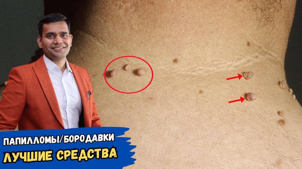 Удаление Папиллом И Бородавок | Лучшие Домашние Средства - YouTube