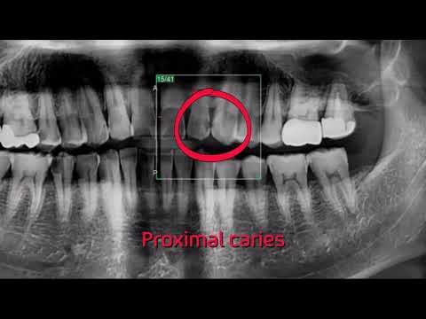 Insight Pan Cases | Periapical lesion - post endodontic treatment ...