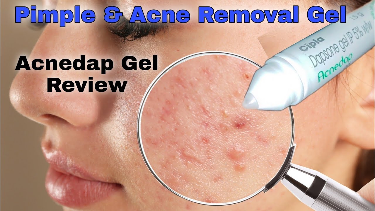 Acne & Pimple Ke Liye Best Acnedap Gel Review in Hindi || Uses and ...