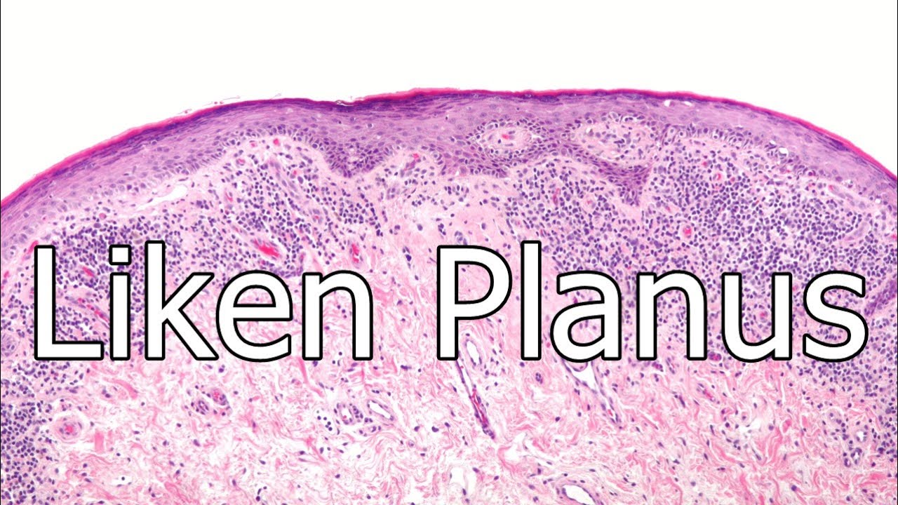 Liken Planus - (Binaural / Isochronic / Enerji Frekansı) - YouTube