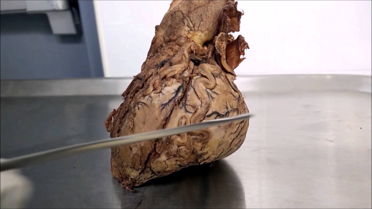 Disección de corazón - Anatomía de superficie - YouTube