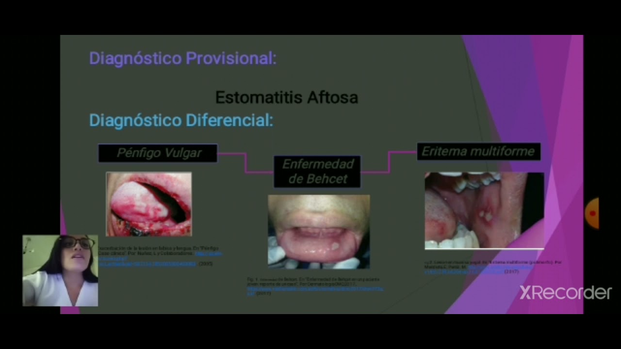 ESTOMATITIS AFTOSA RECURRENTE - YouTube
