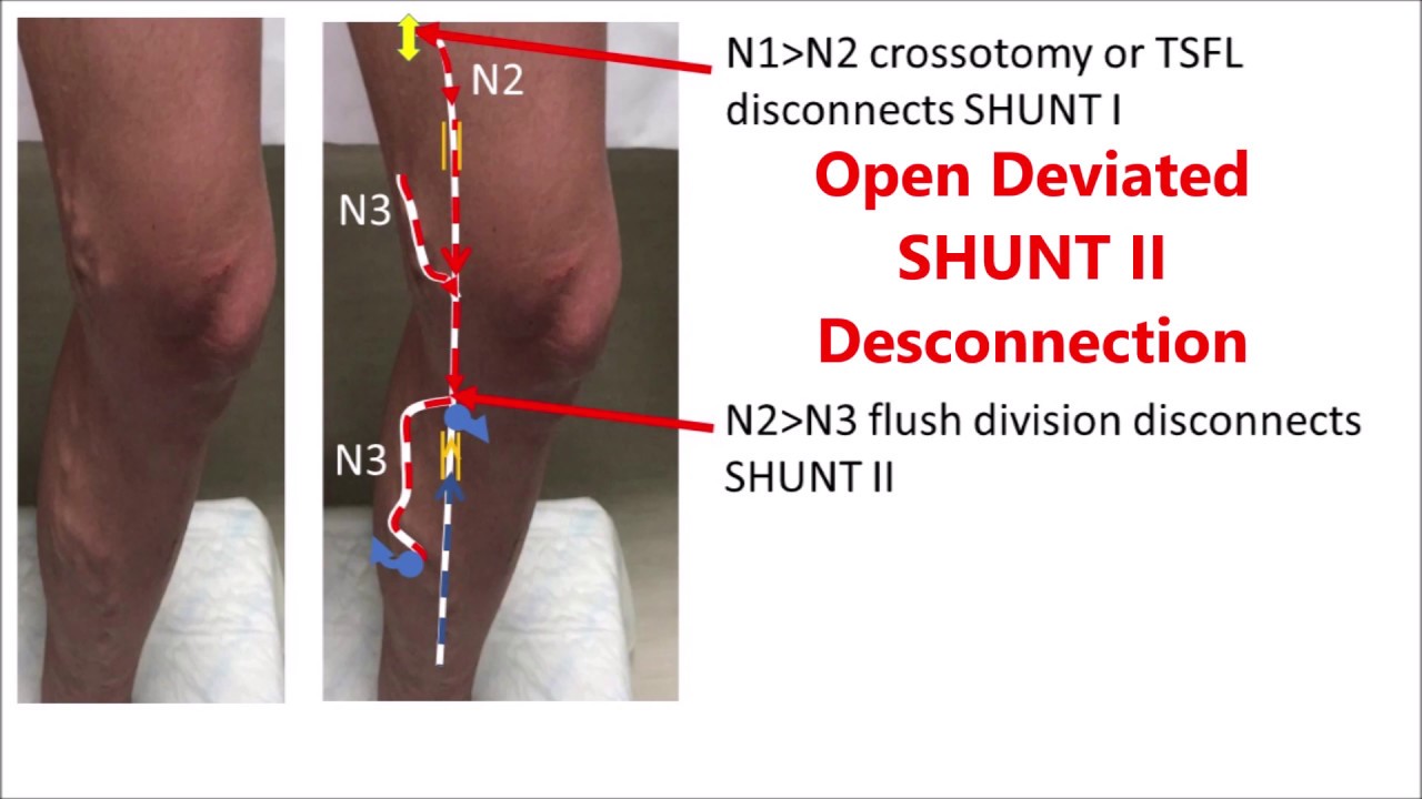 CHIVA shunt III devalvulation - YouTube